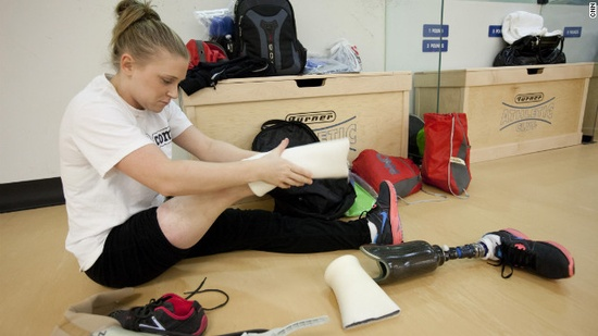 Understanding Post-Operative Below the Knee Amputation Care